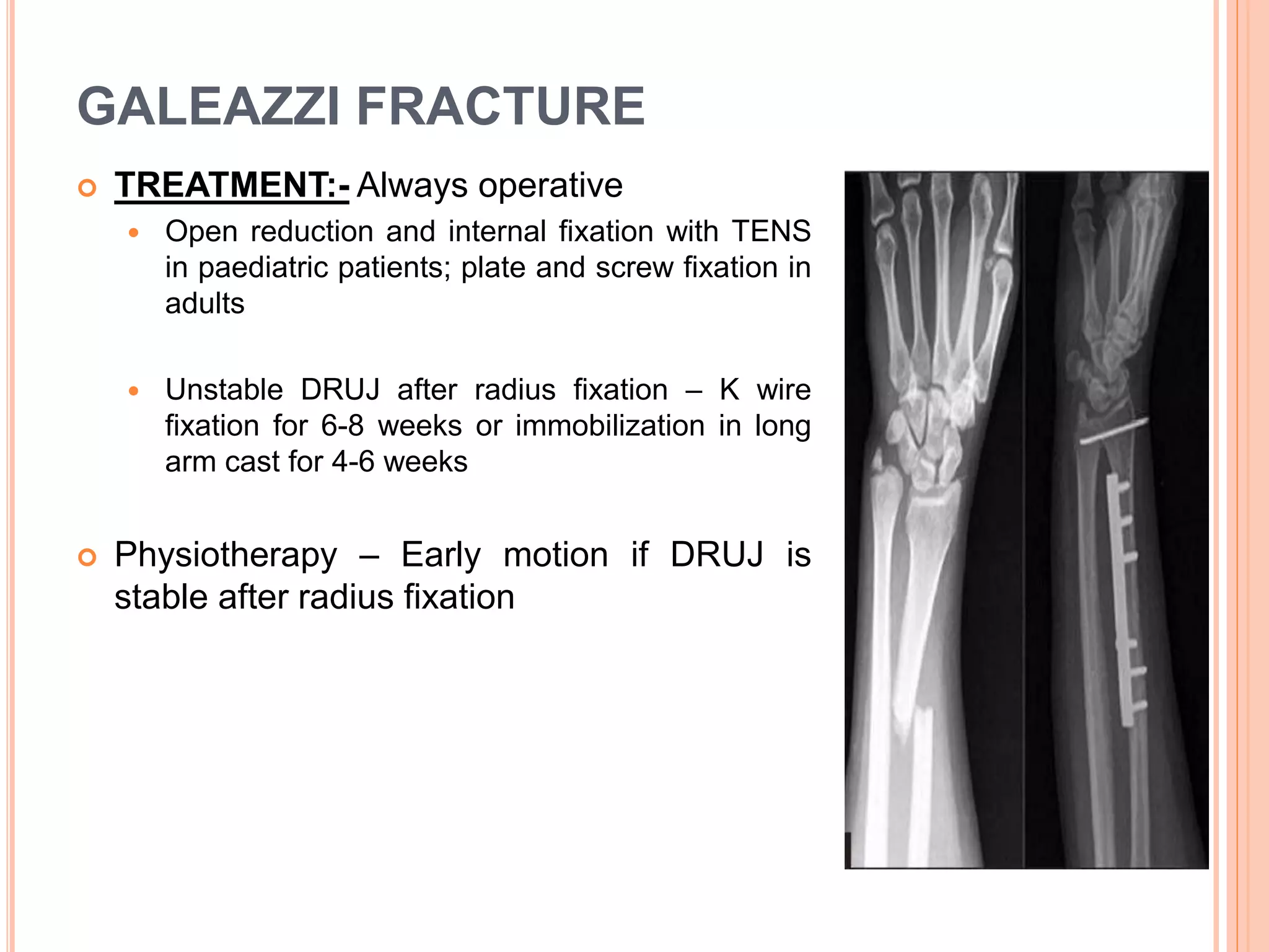 Monteggia fracture & galeazzi fracture | PPTX