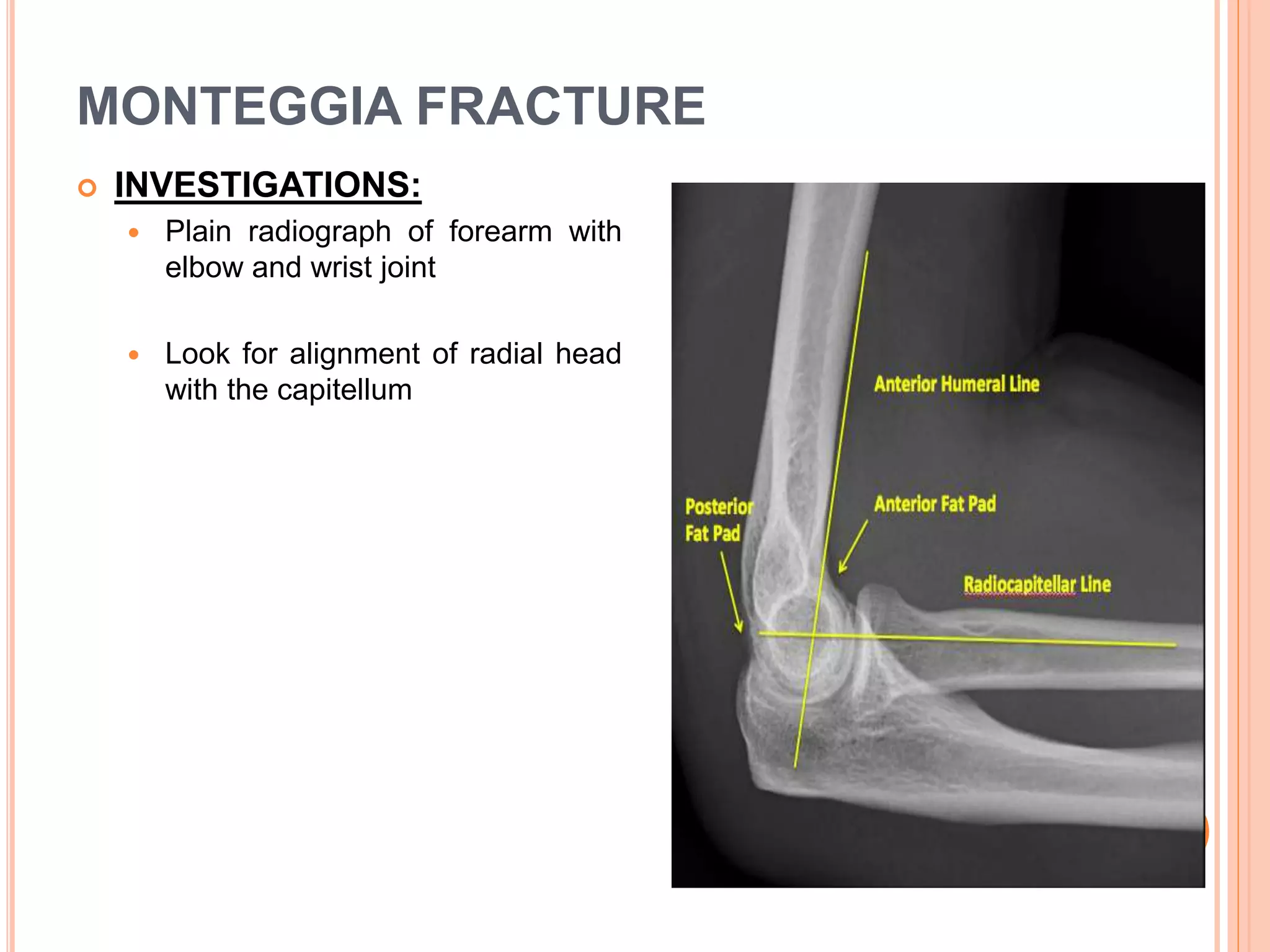 Monteggia fracture & galeazzi fracture | PPTX