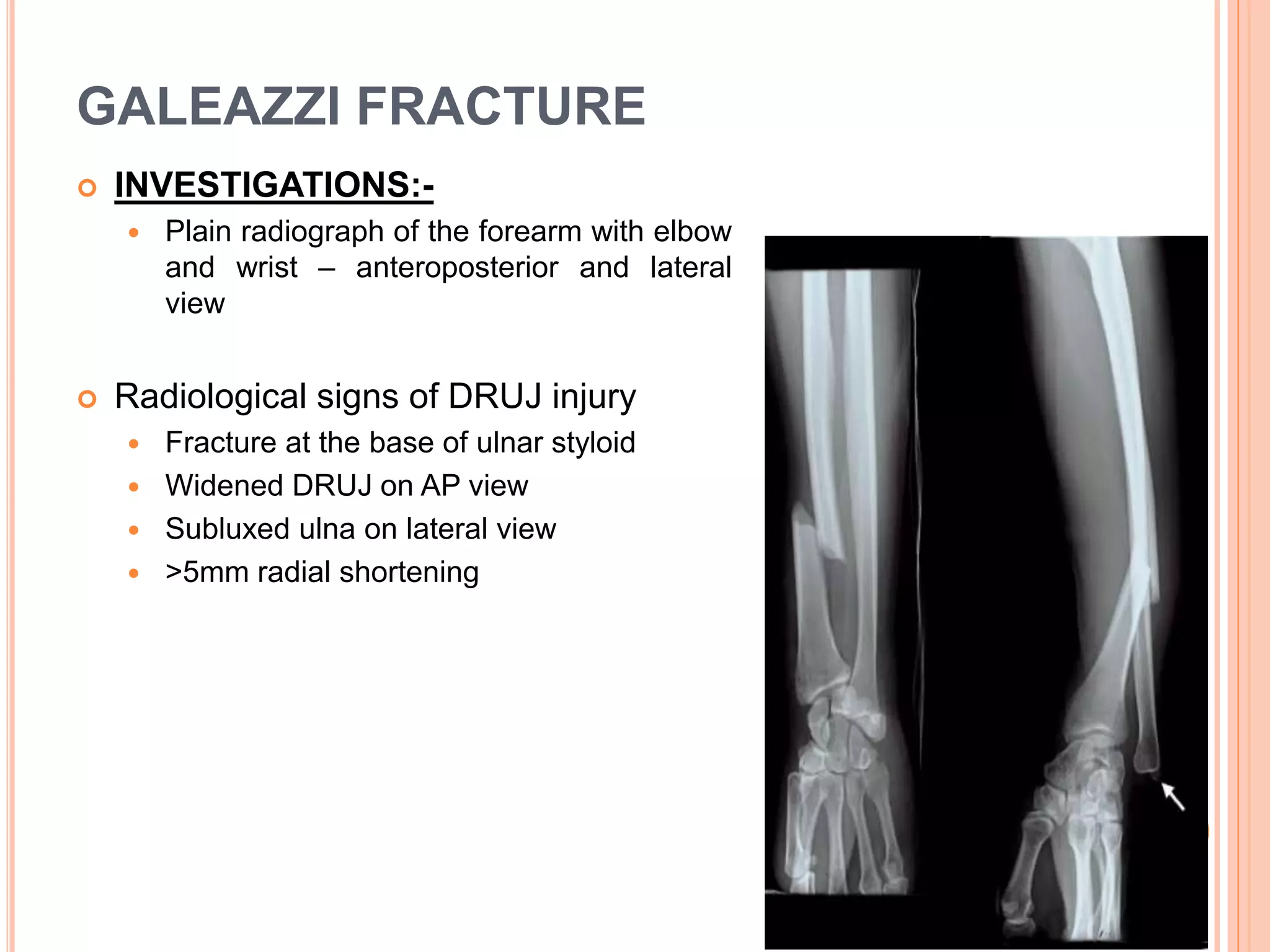 Monteggia fracture & galeazzi fracture | PPTX