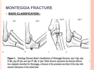 Monteggia fracture & galeazzi fracture | PPTX