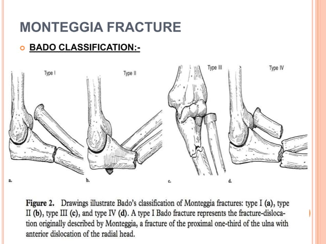 Monteggia fracture & galeazzi fracture