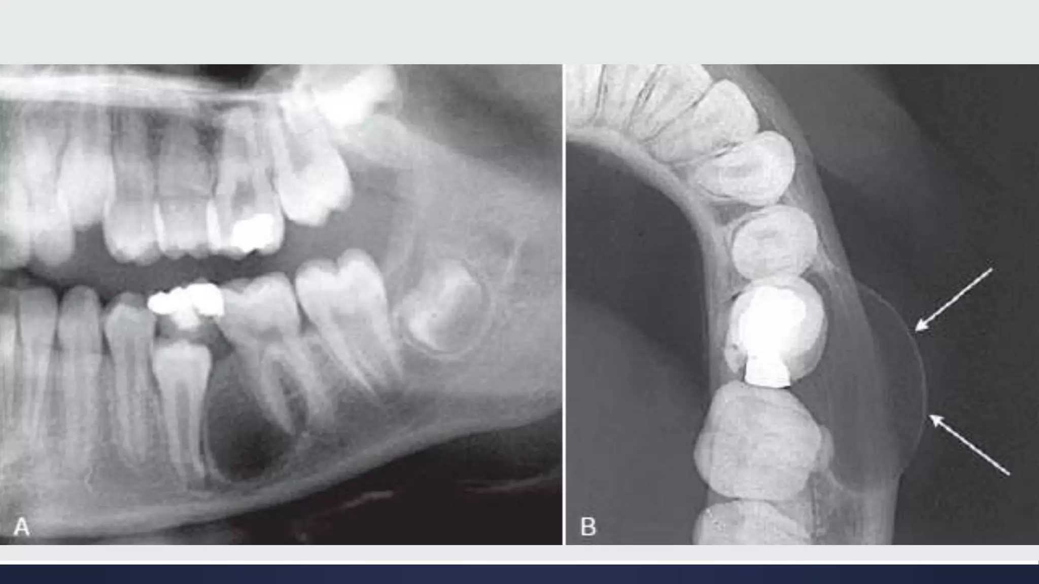Radiographic Interpretation of Cyst and Cyst-like Lesions of the Jaws ...