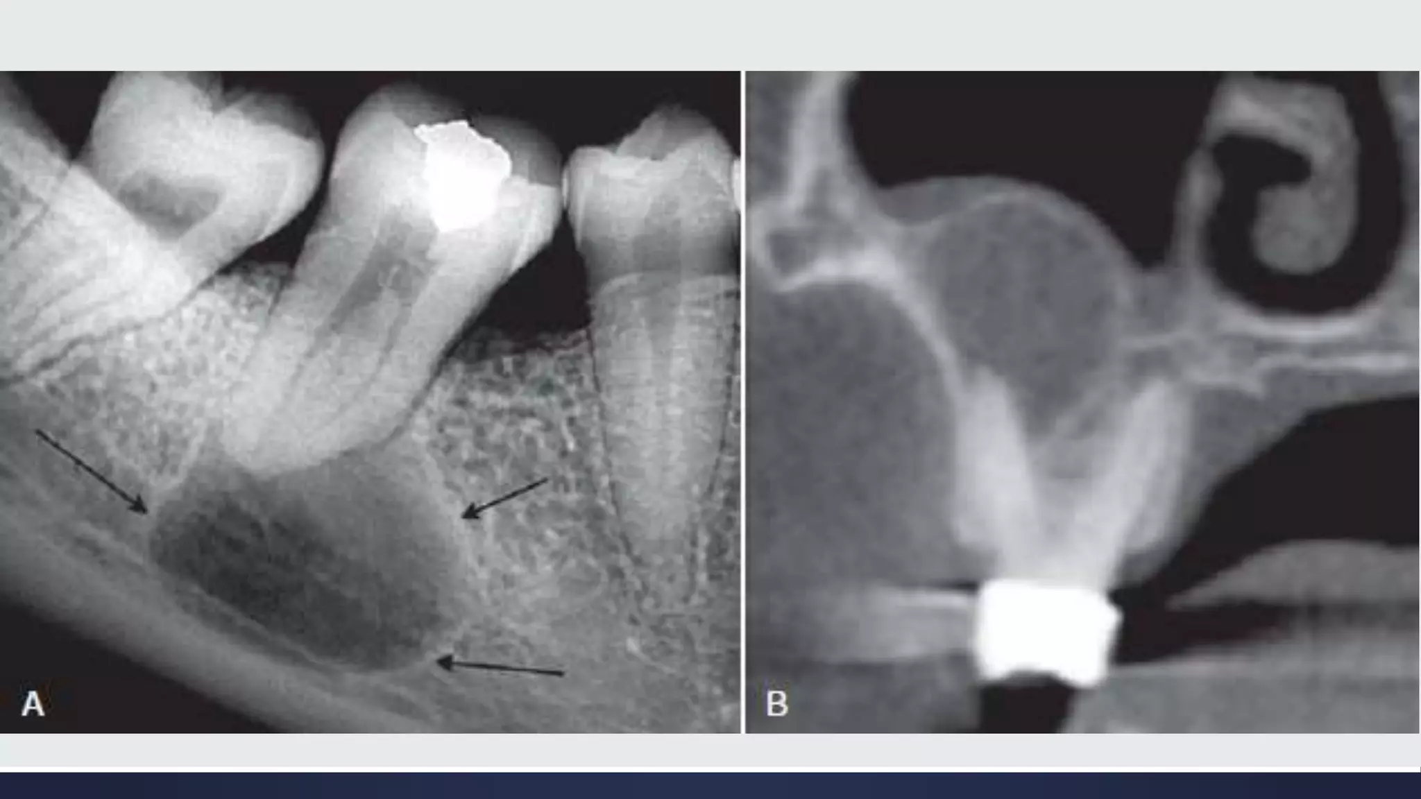Radiographic Interpretation Of Cyst And Cyst Like Lesions Of The Jaws Ppt