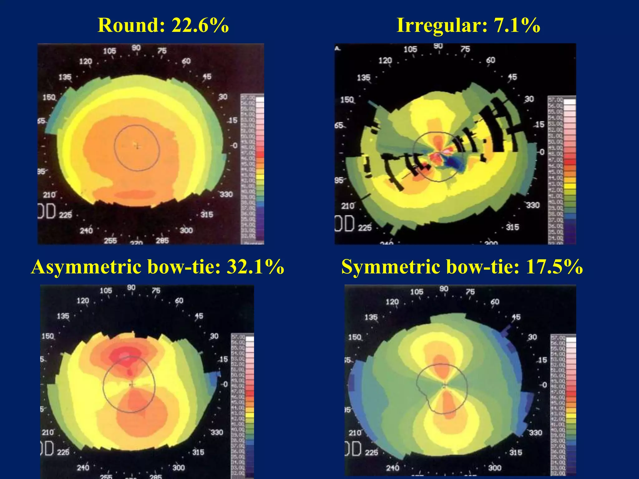 Corneal topography | PPT