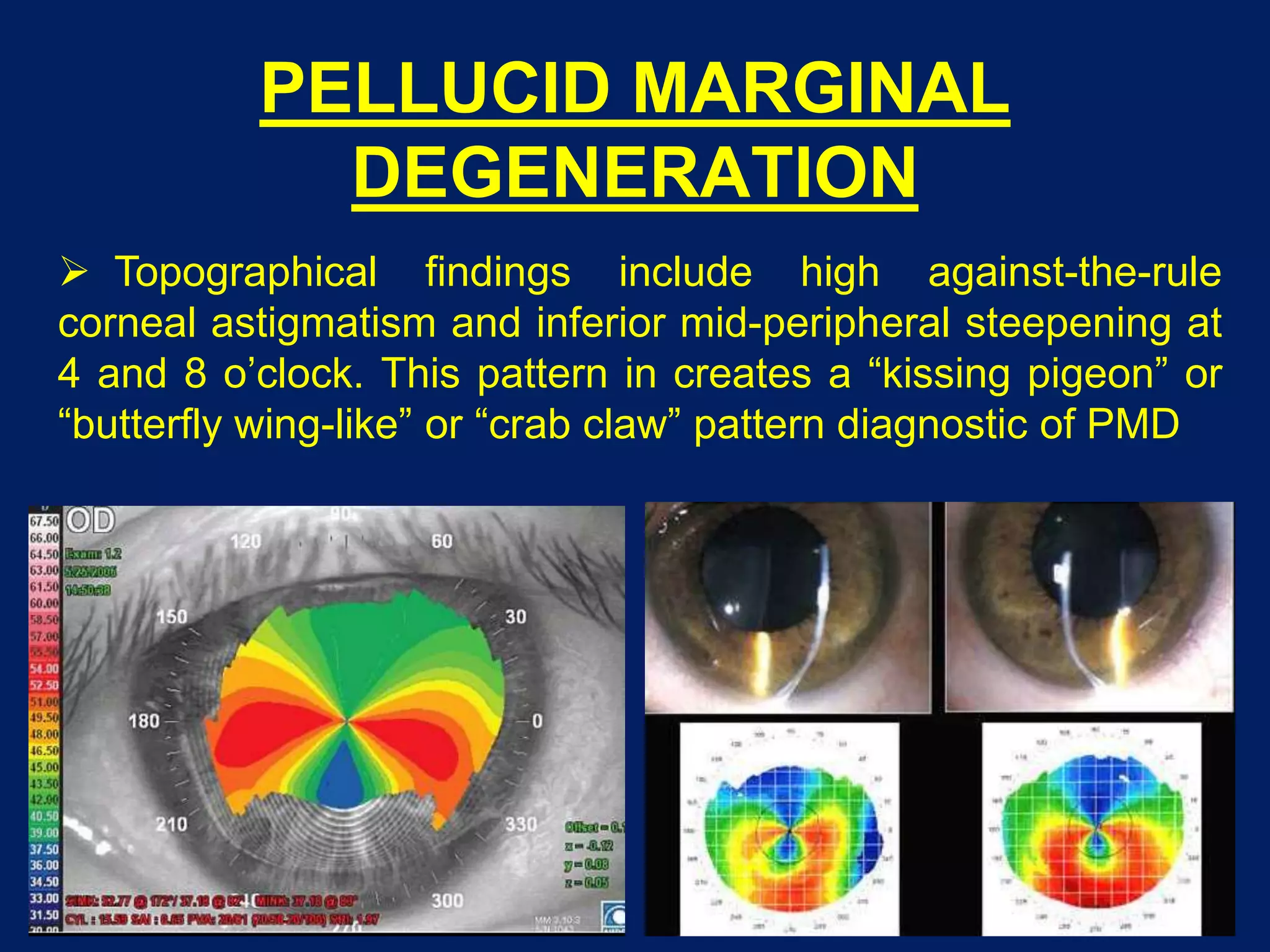 Corneal topography | PPT