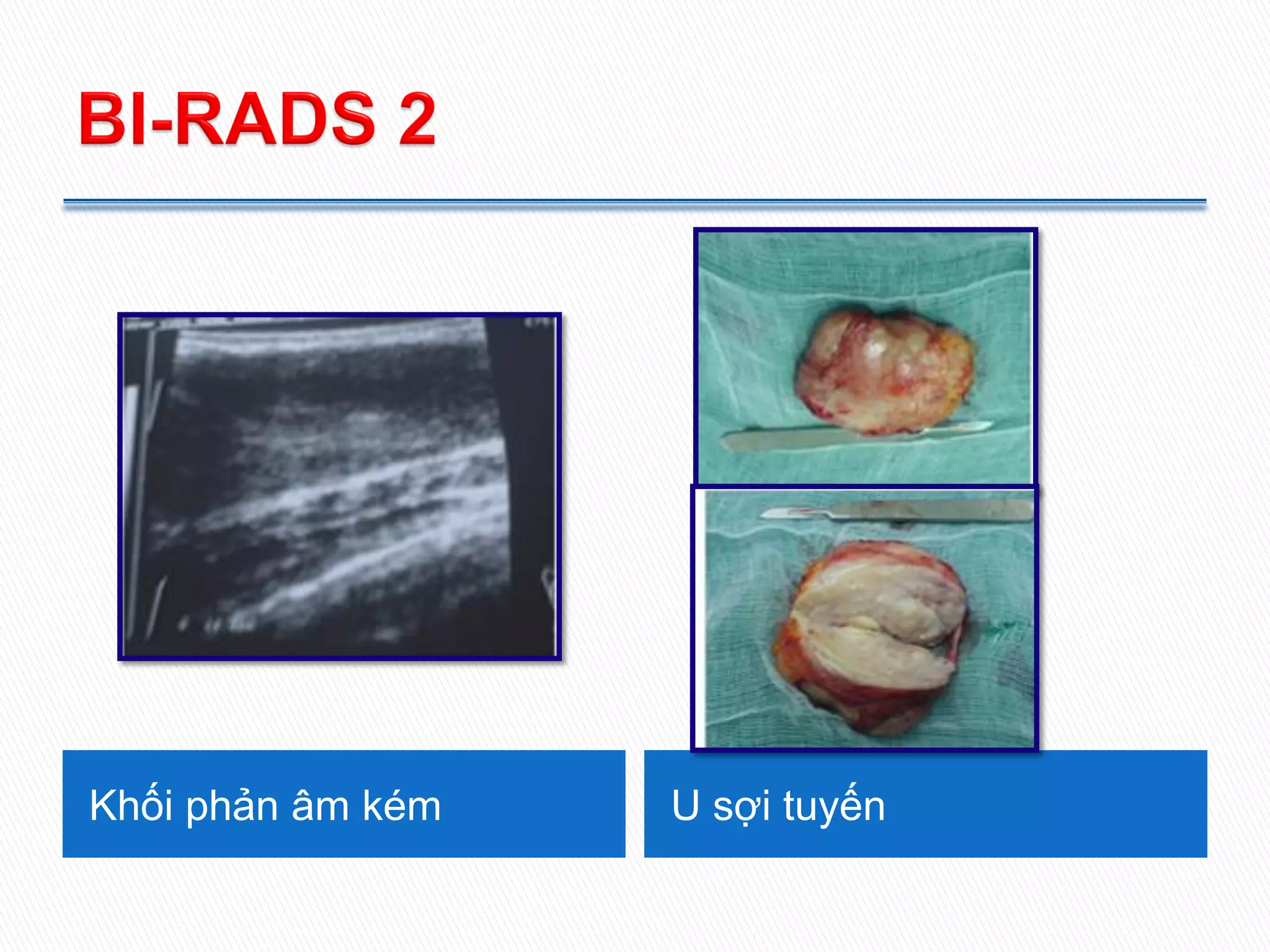 BI - RADS - SIÊU ÂM VÚ | PDF