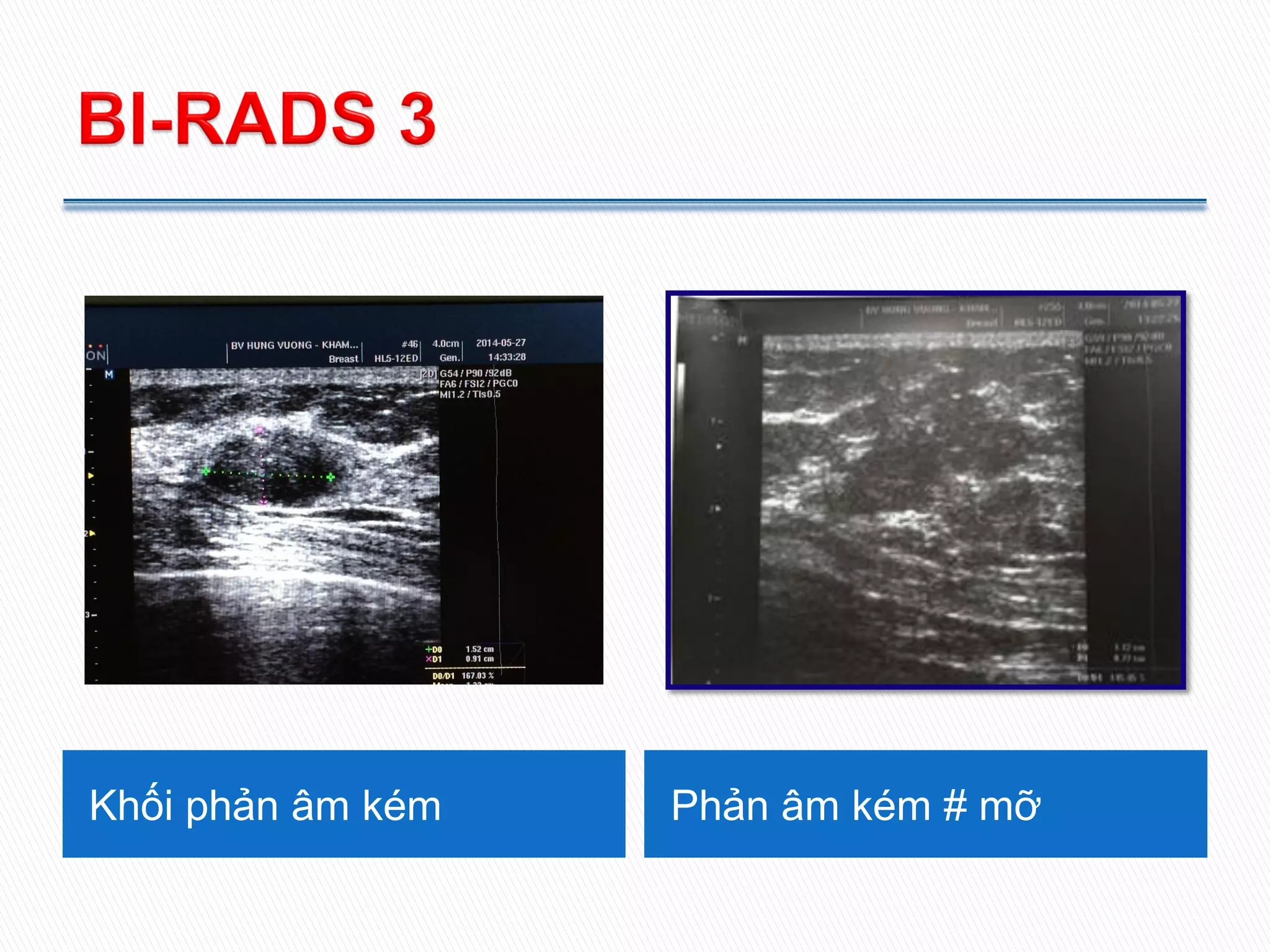 BI - RADS - SIÊU ÂM VÚ | PDF