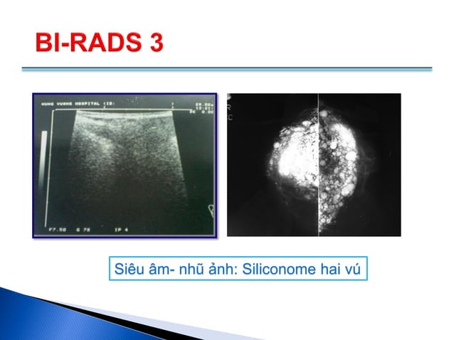 BI - RADS - SIÊU ÂM VÚ | PDF