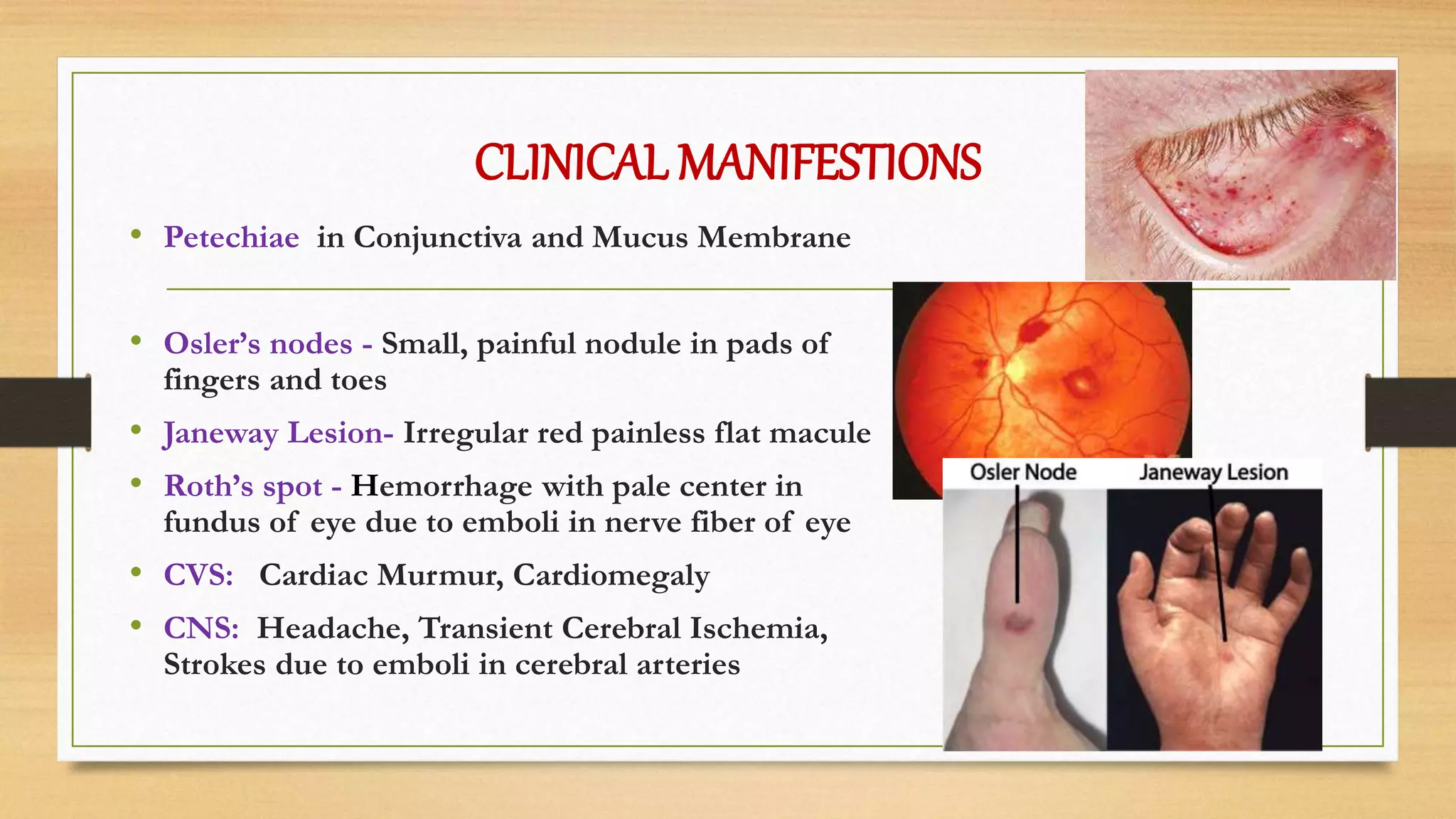 8.endocarditis | PPTX