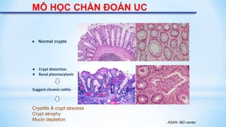 8. diagnosis and treatment ulcerative colitis bs trịnh thị thanh thúy | PPT