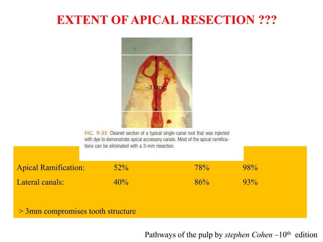 Retro grade filling | PPT | Dental Health | Diseases and Conditions