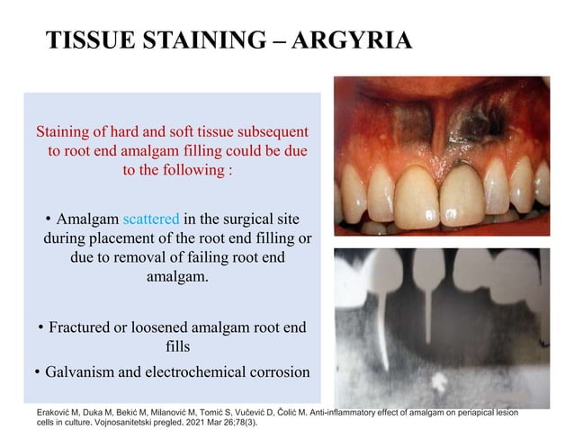 Retro grade filling | PPT | Dental Health | Diseases and Conditions