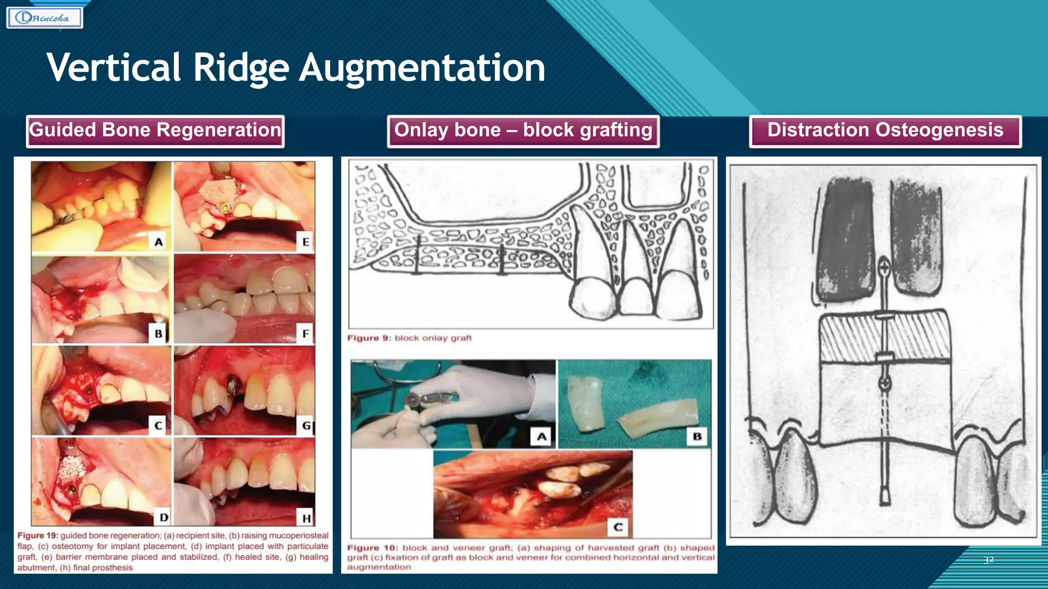 Hard Tissue Augmentation.pptx