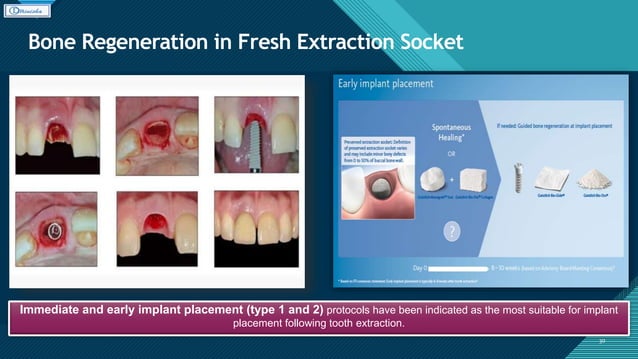 Hard Tissue Augmentation.pptx