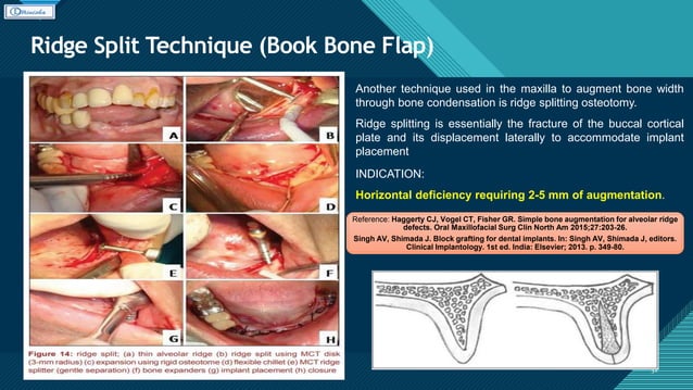 Hard Tissue Augmentation.pptx
