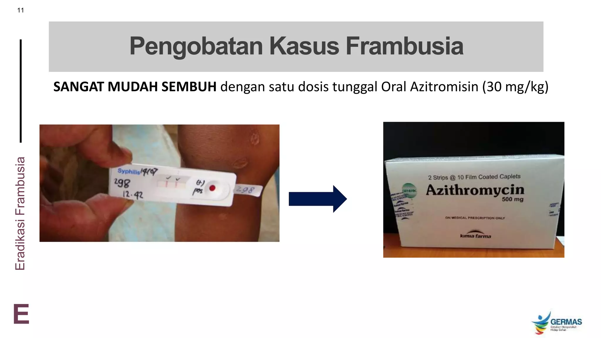 Paparan Sosialisasi Klinis Frambusia.pptx