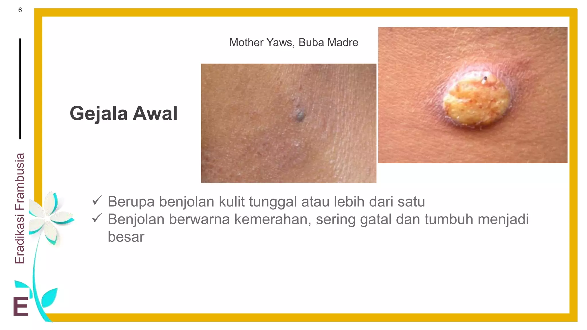 Paparan Sosialisasi Klinis Frambusia.pptx