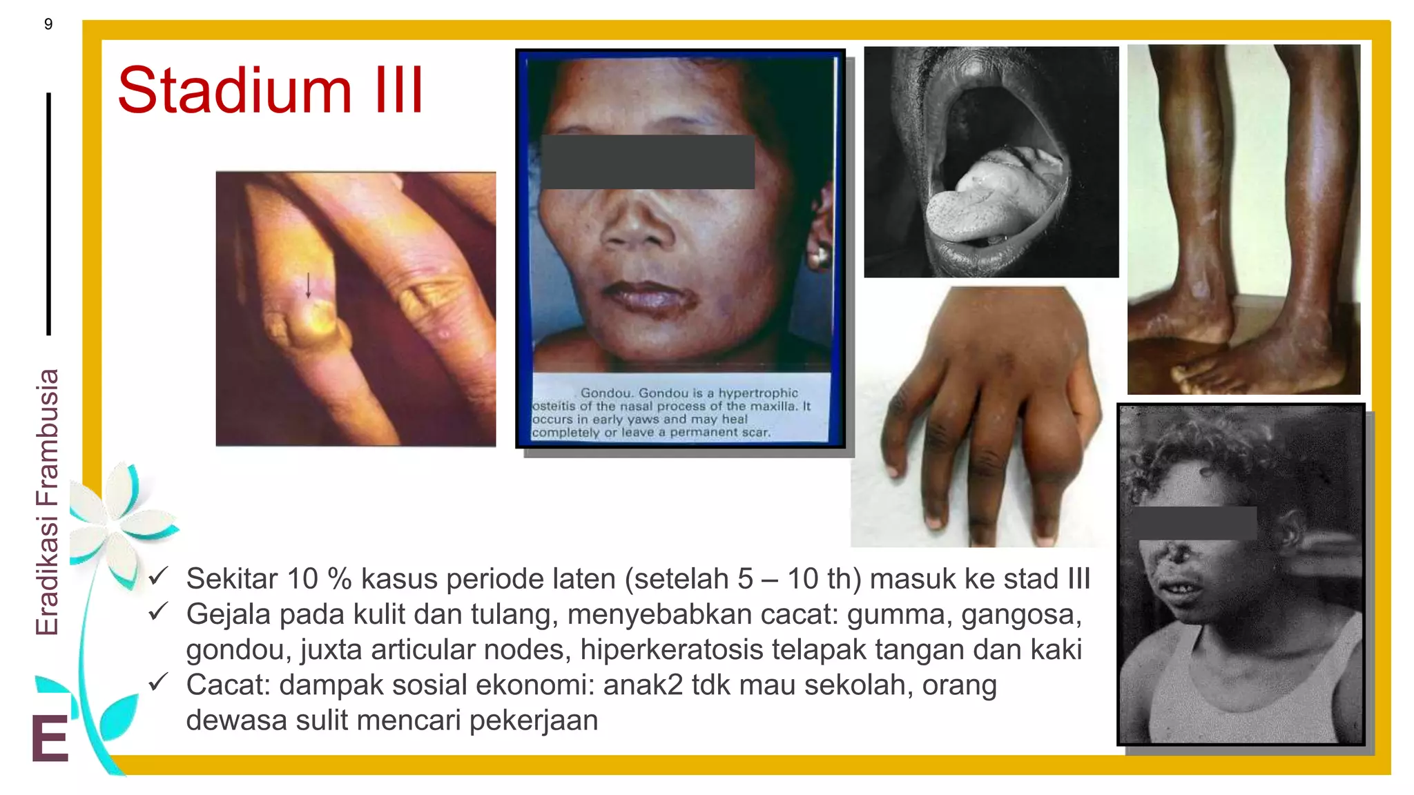 Paparan Sosialisasi Klinis Frambusia.pptx