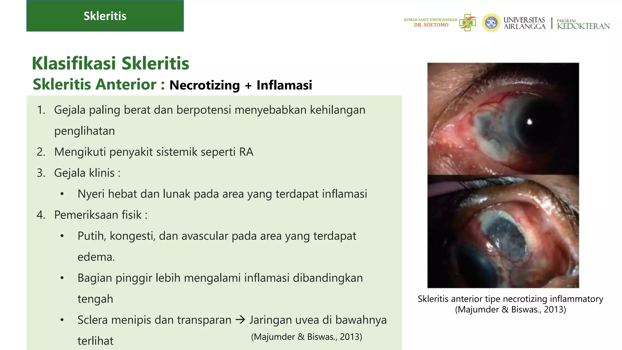 8. PPT Skleritis Episkleritis_Adinda Sandya P._011923143086.pptx