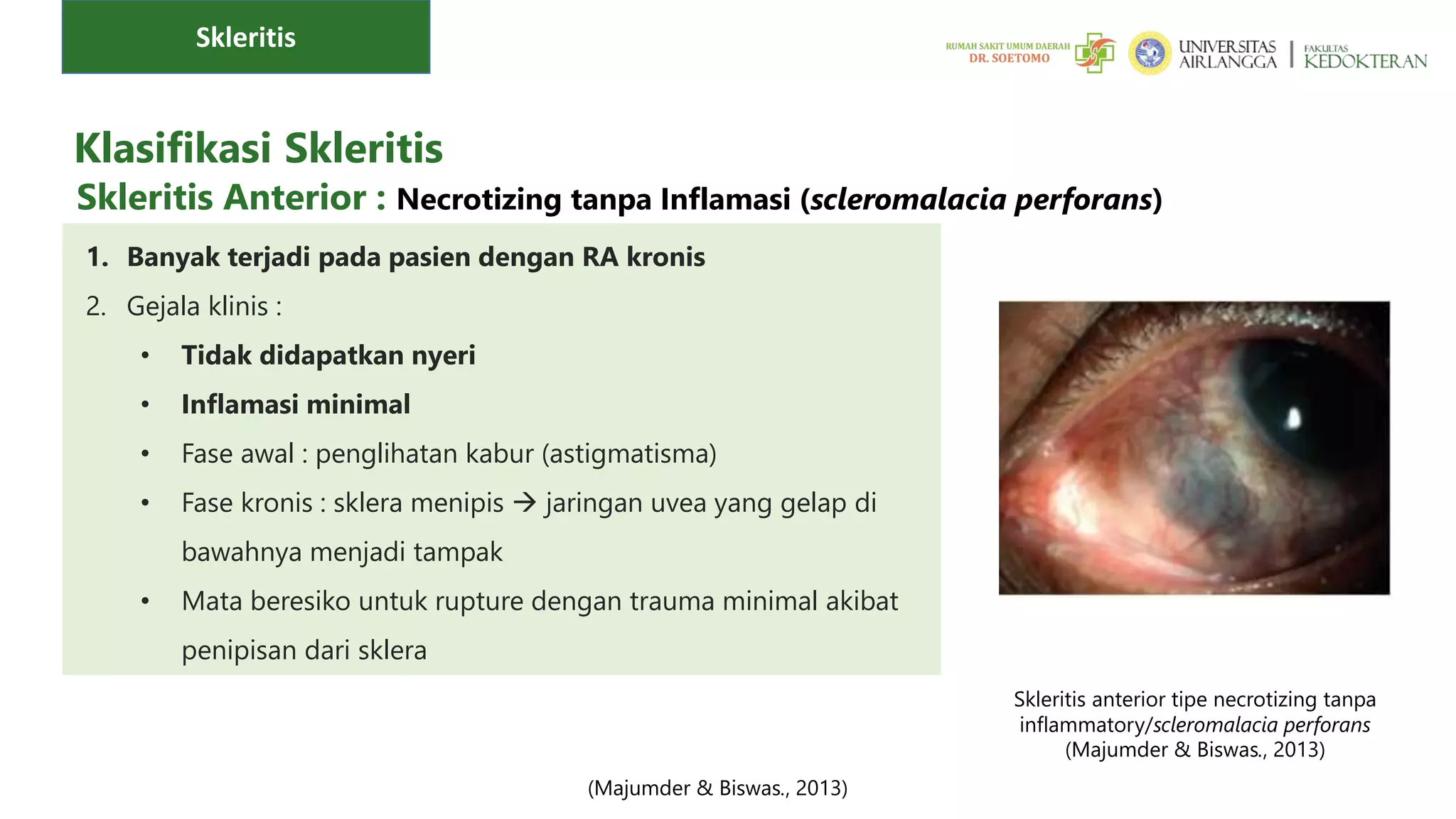 8. PPT Skleritis Episkleritis_Adinda Sandya P._011923143086.pptx