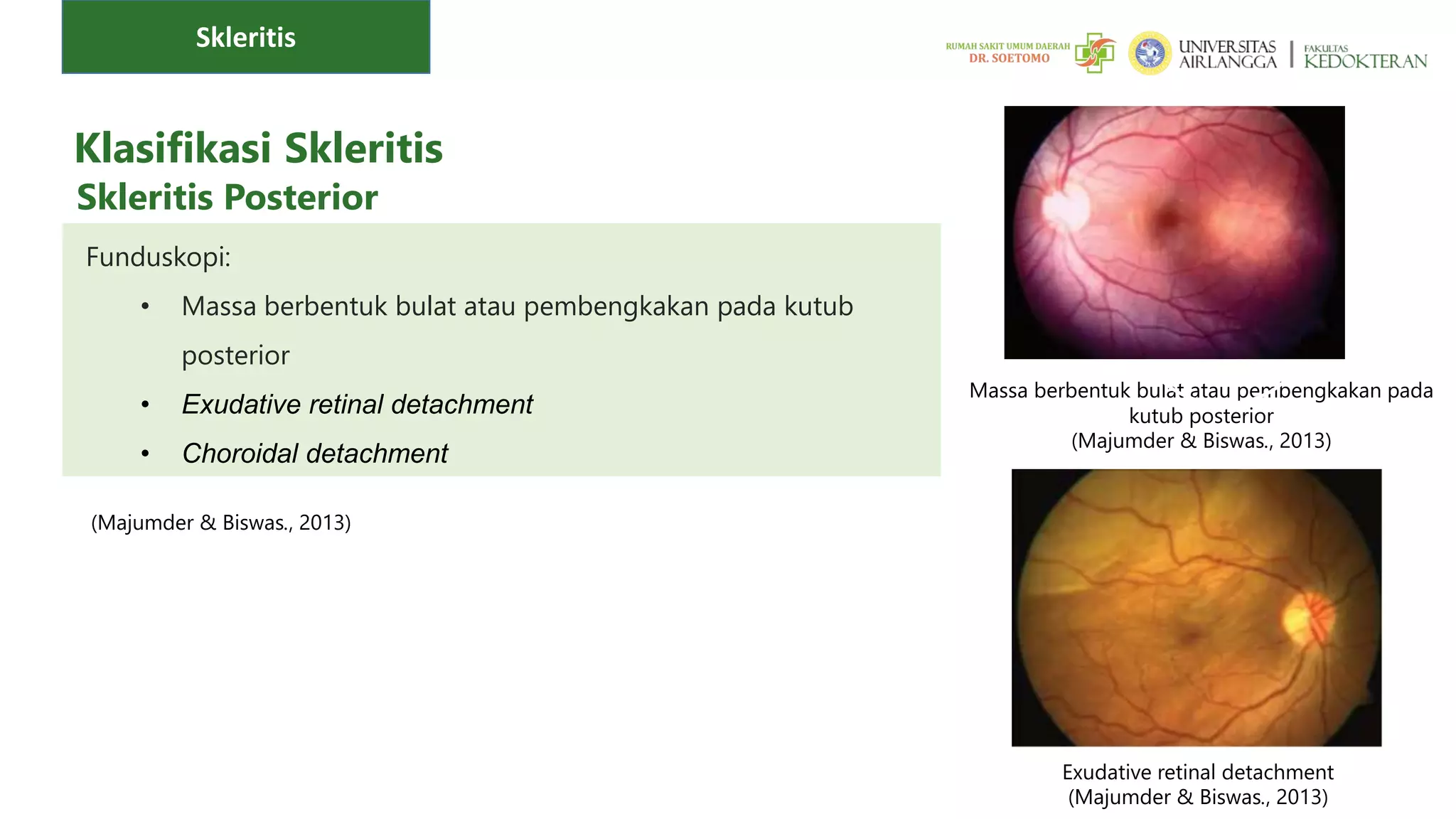 8. PPT Skleritis Episkleritis_Adinda Sandya P._011923143086.pptx