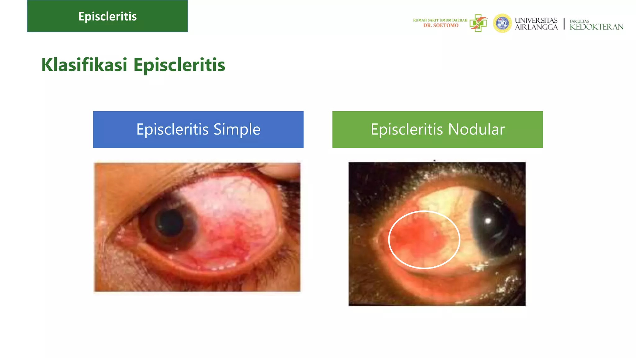 8. PPT Skleritis Episkleritis_Adinda Sandya P._011923143086.pptx