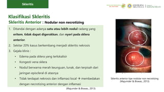 8. PPT Skleritis Episkleritis_Adinda Sandya P._011923143086.pptx