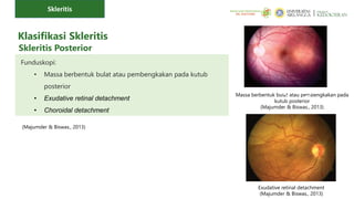8. PPT Skleritis Episkleritis_Adinda Sandya P._011923143086.pptx