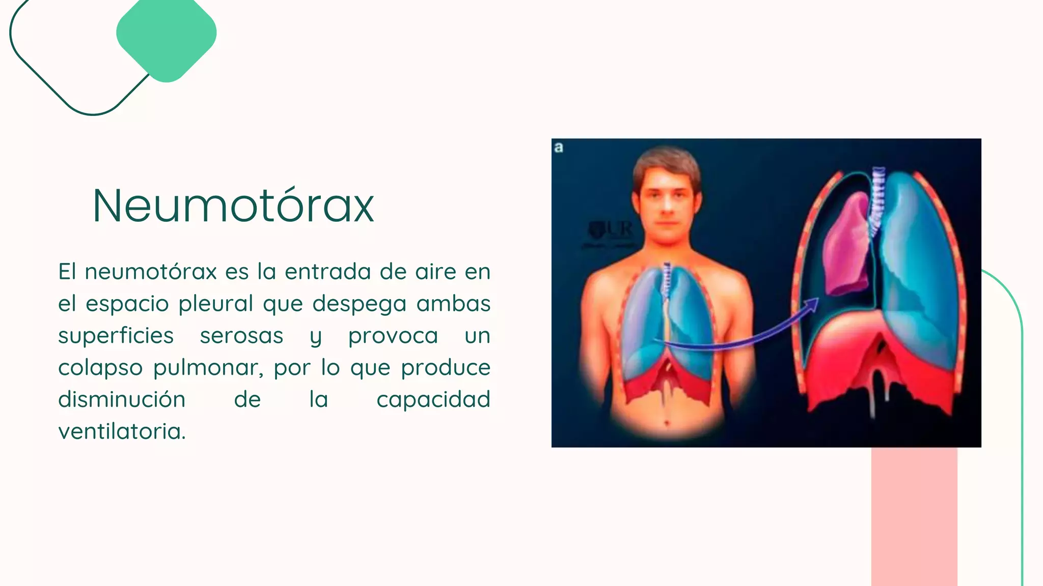 8. Andrea Borrero - Neumotórax .pptx