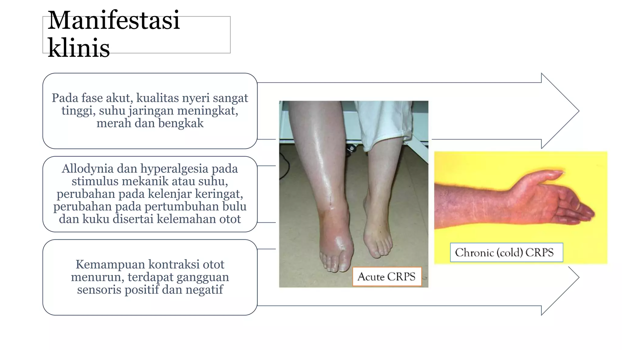 8. Complex regional Pain Syndrome.pptx