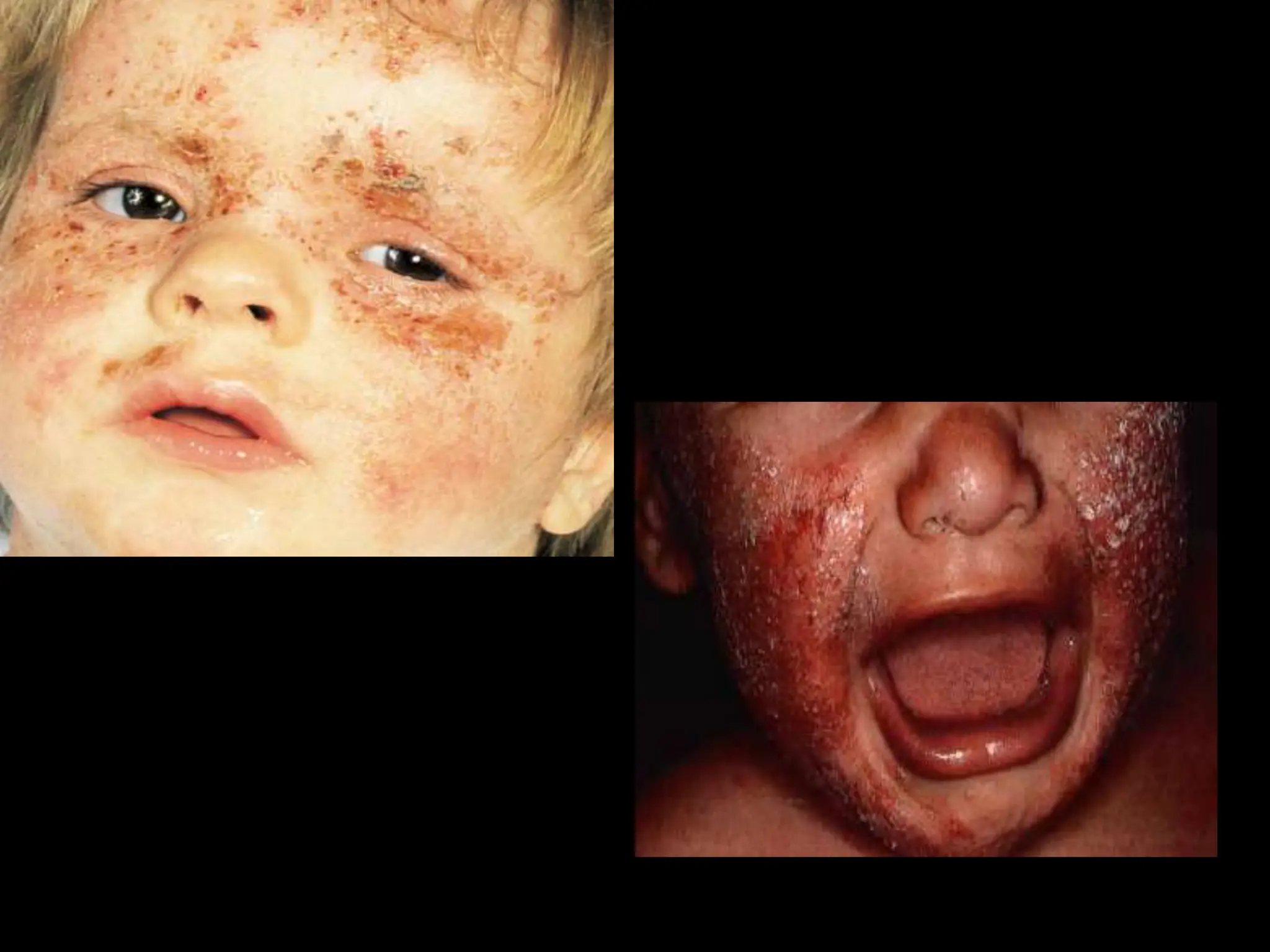 8.Atopic dermatitis.ppt