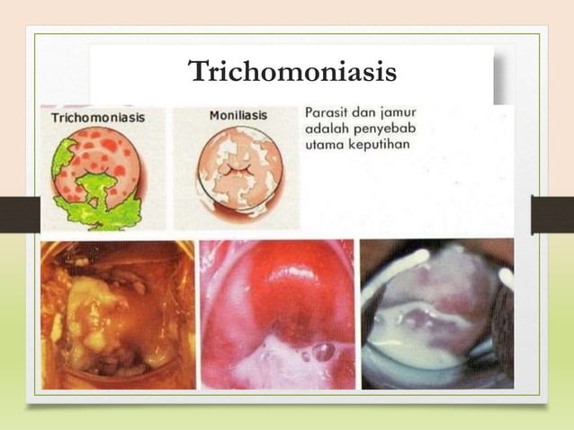 Trichomoniasis..........................pptx