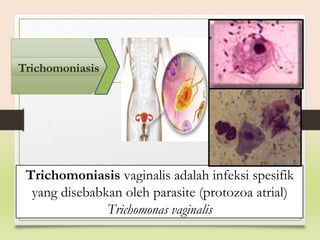 Trichomoniasis..........................pptx