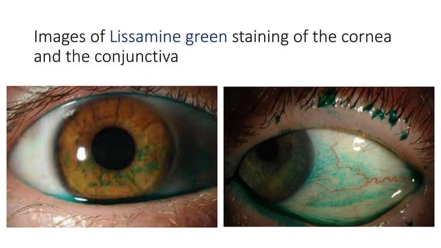 Vital dyes and stains Used in Ophthalmic Practice.pptx