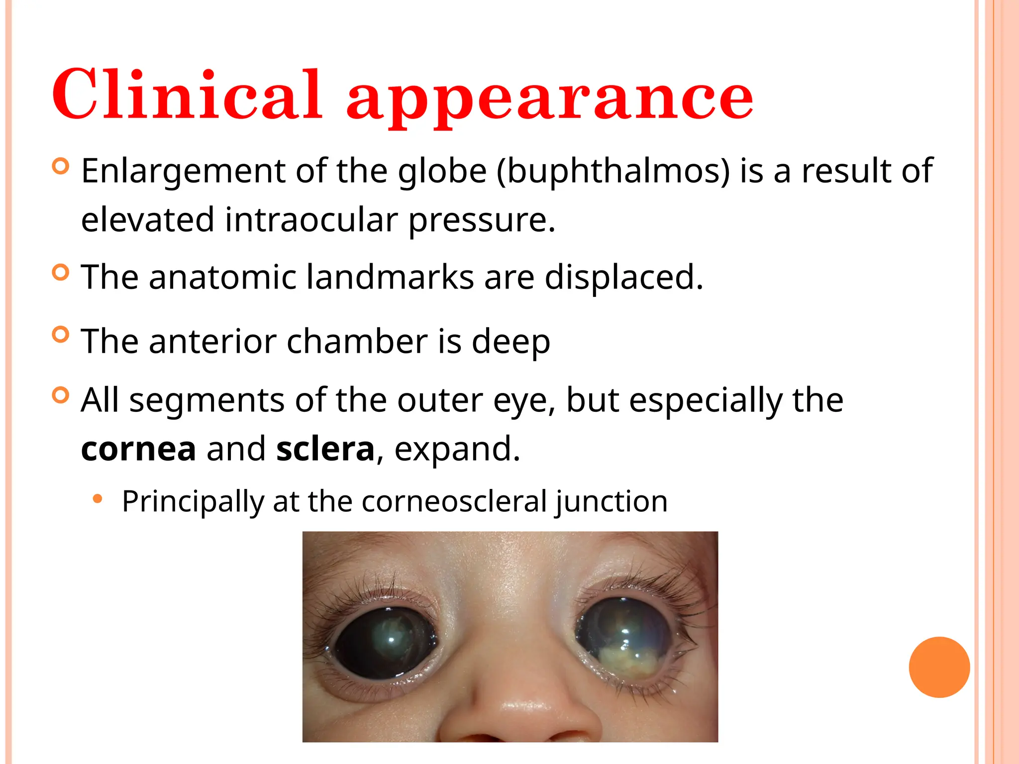 Chapter 1. GLAUCOMA lecture three3 .ppt