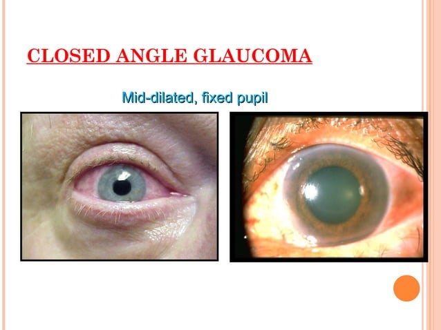 Chapter 1. GLAUCOMA lecture three3 .ppt | Eye and Vision Conditions | Diseases and Conditions
