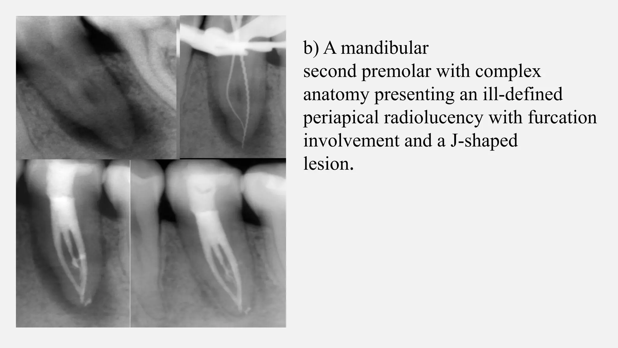 INTRACANAL MEDICAMENT IN ENDODONTICS. pptx | PPTX