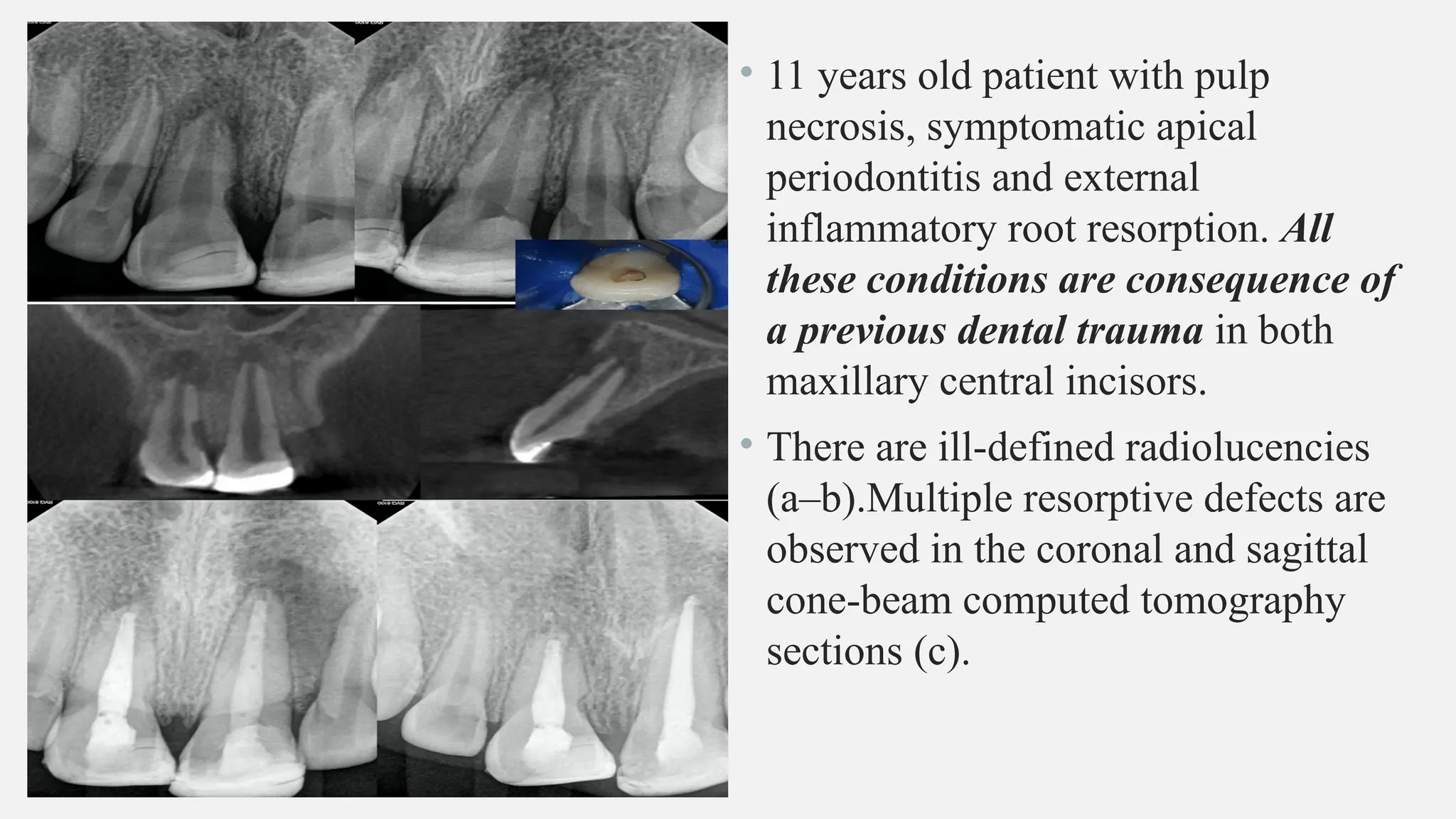INTRACANAL MEDICAMENT IN ENDODONTICS. pptx | PPTX
