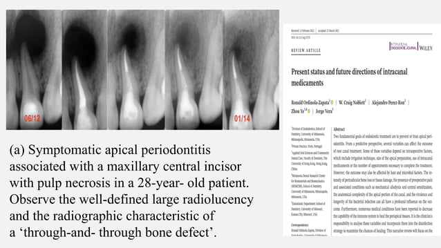 INTRACANAL MEDICAMENT IN ENDODONTICS. pptx | PPTX
