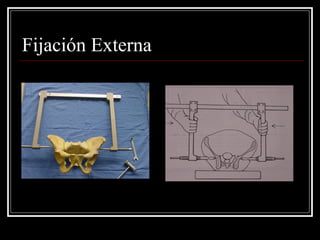 Fractura de Pelvis Traumatología y Ortopedia | PPT