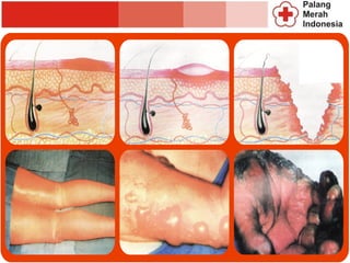Pertolongan Pertama pada luka bakar..... | PPT