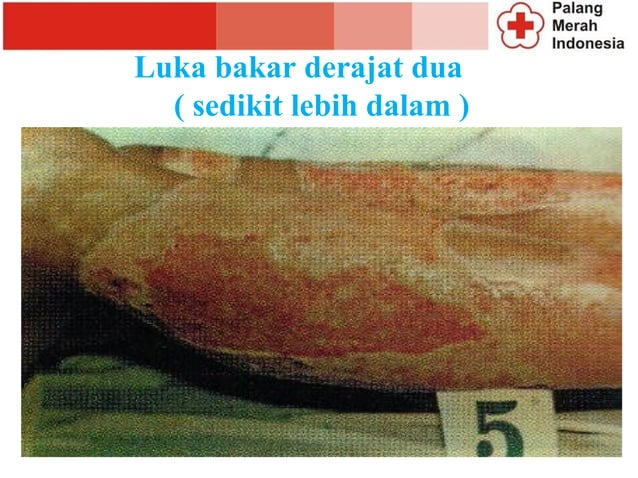 Pertolongan Pertama pada luka bakar..... | PPT