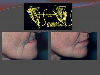 Setting anterior teeth complete denture | PPTX