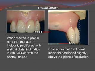 Setting anterior teeth complete denture | PPTX