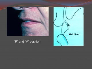 Setting anterior teeth complete denture | PPTX
