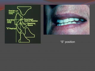 Setting anterior teeth complete denture | PPTX