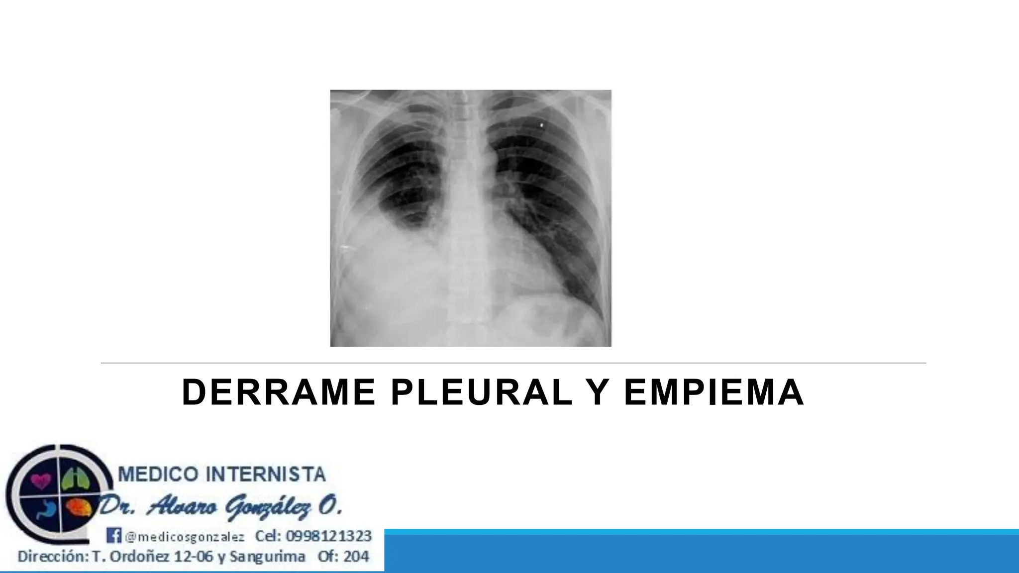 DERRAME PLEURAL COMO COMPLICACION DE NEUMONIA MAS EMPIEMA | PDF