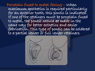 8. PONTIC DESIGN IN FIXED PROSTHODONTICS.pptx