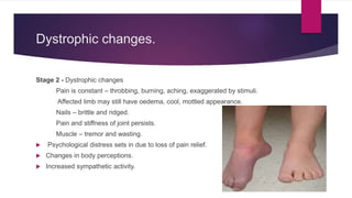 sudecks osteodystrophy | PPTX