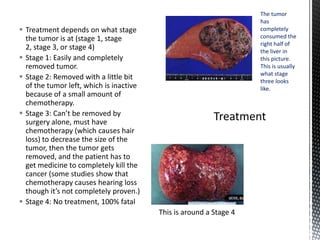 Hepatoblastome | PPTX